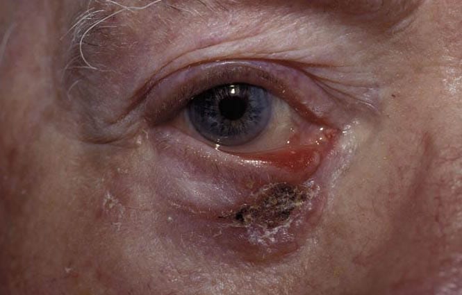 Eyelid Skin Cancer - mivision