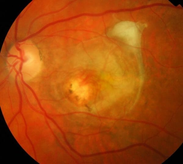 Myopic Maculopathy Vision Study - mivision