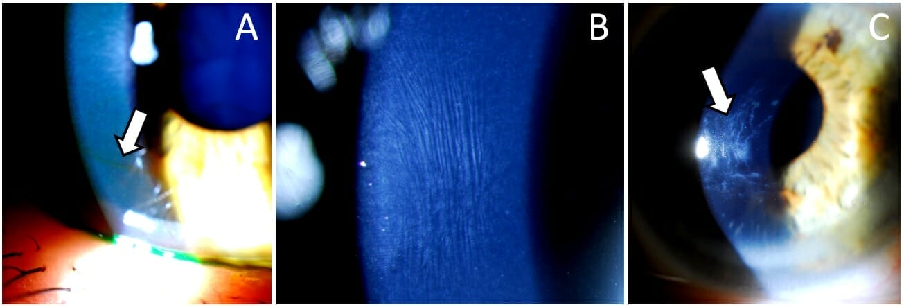 Strengthening Keratoconus Management - mivision