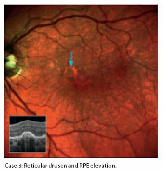 Spectralis OCT: MultiColor Scanning Laser - mivision