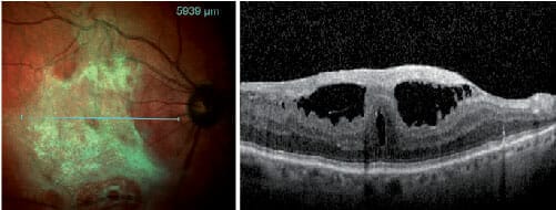 Spectralis OCT: MultiColor Scanning Laser - mivision