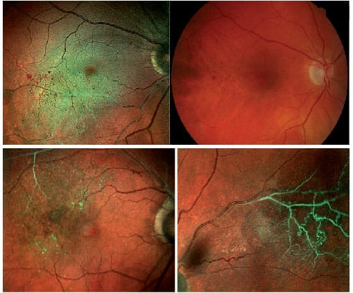 Spectralis OCT: MultiColor Scanning Laser - mivision