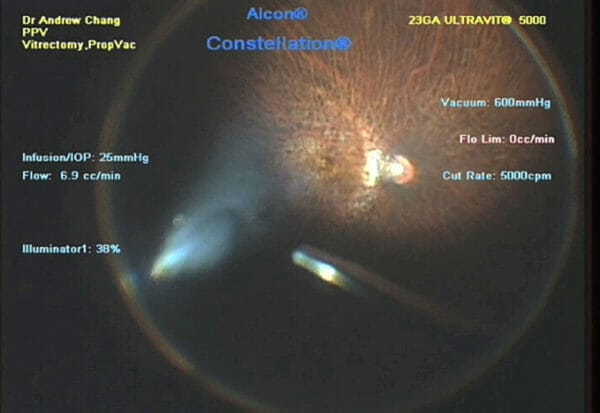 Understanding Myopic Tractional Maculopathy - mivision