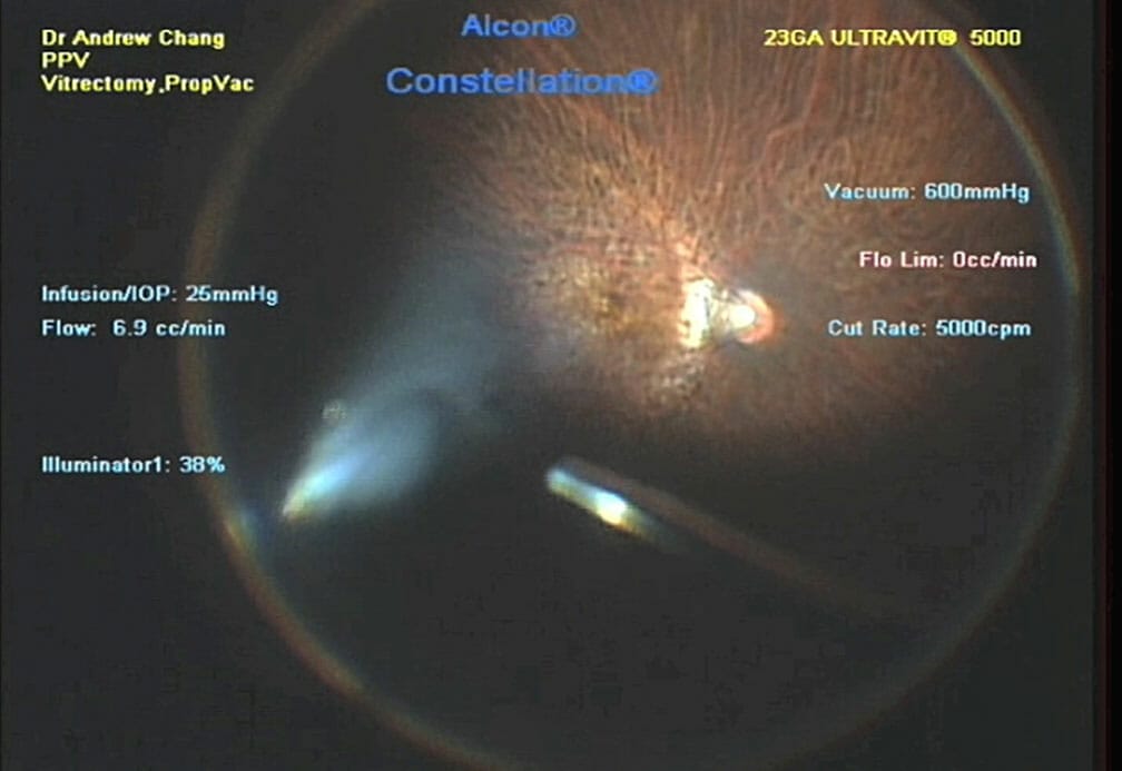 Understanding Myopic Tractional Maculopathy - mivision