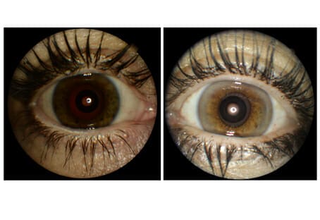 Treating Presbyopia with Corneal Inlays - mivision