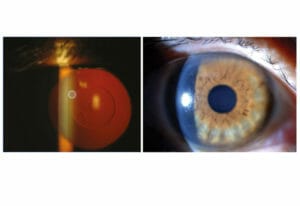 Treating Presbyopia with Corneal Inlays - mivision