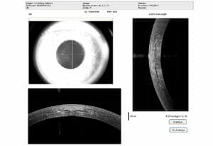 Treating Presbyopia with Corneal Inlays - mivision