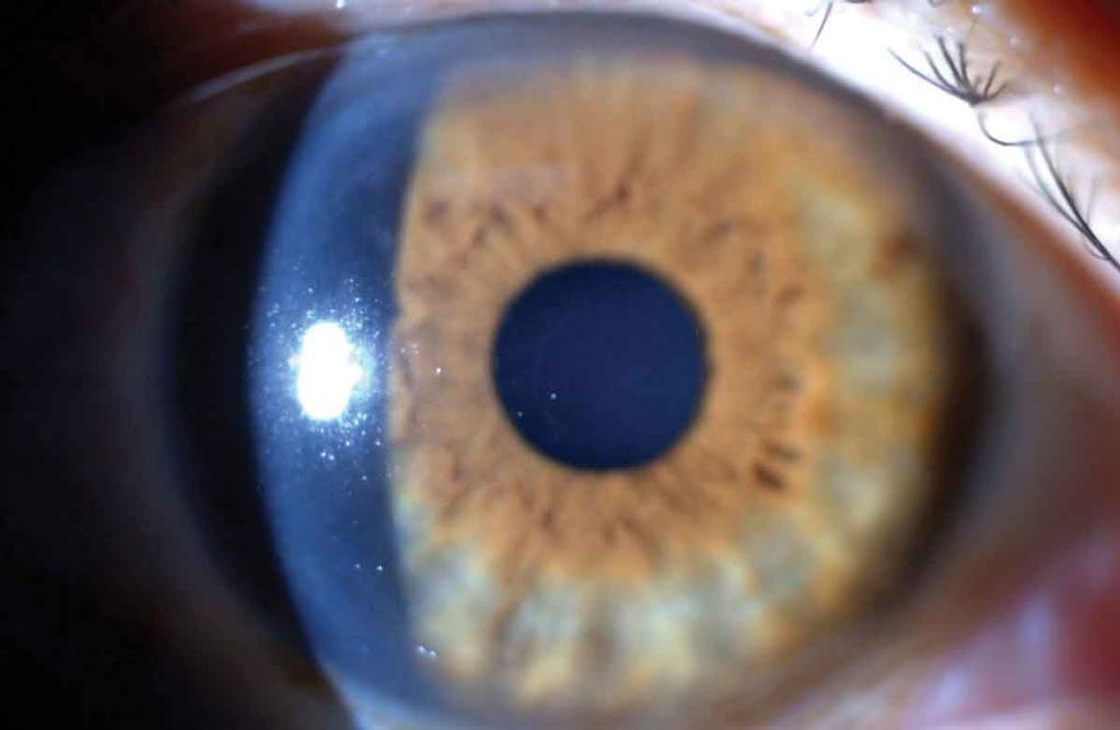 Corneal Inlays to Correct Presbyopia - mivision