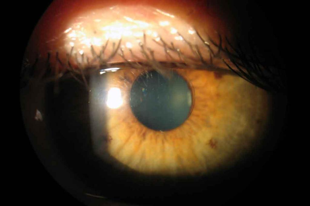 Corneal Inlays to Correct Presbyopia - mivision