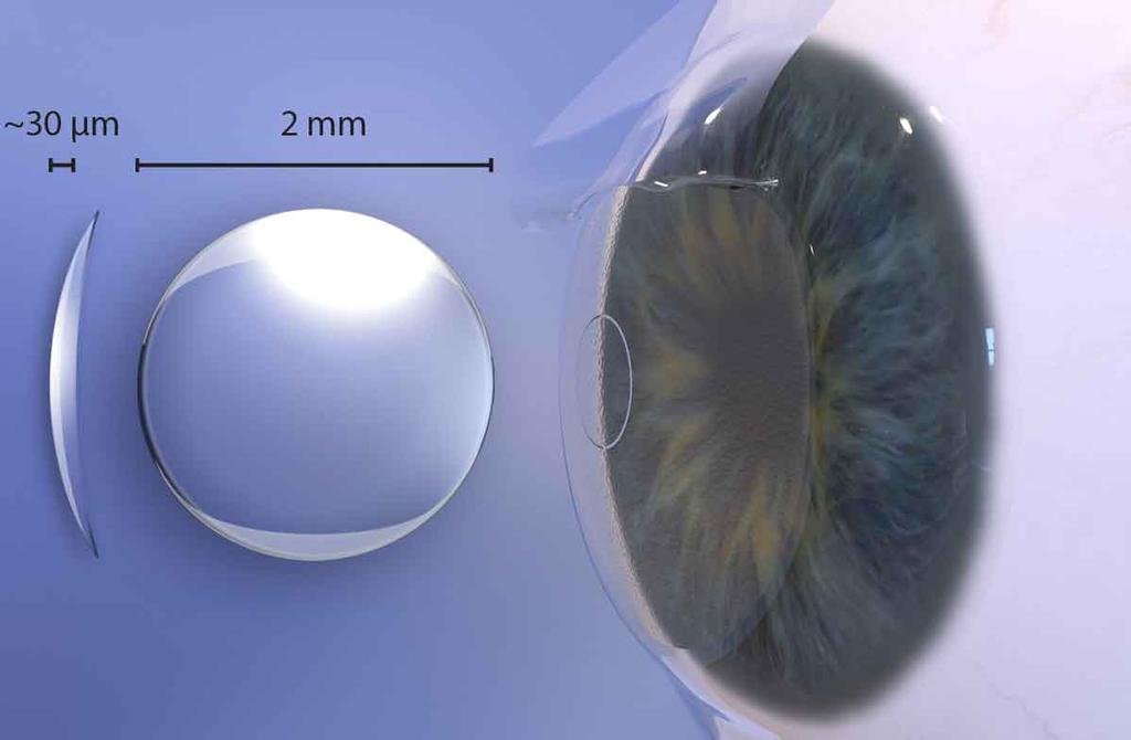 Corneal Inlays to Correct Presbyopia - mivision