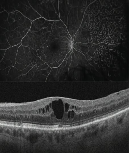 Diabetic Maculopathy – Through an Artist's Eyes - mivision