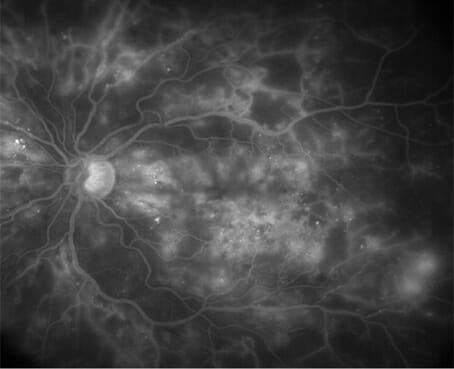 Diabetic Maculopathy – Through an Artist's Eyes - mivision