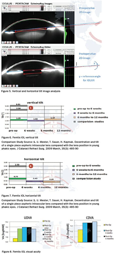 Oculentis FEMTIS Intraocular Lenses - A Revolutionary New Design - mivision