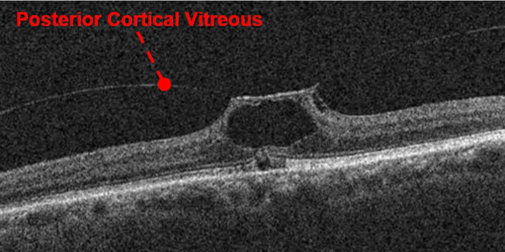 OCT and Me – A Beginner’s Guide - mivision