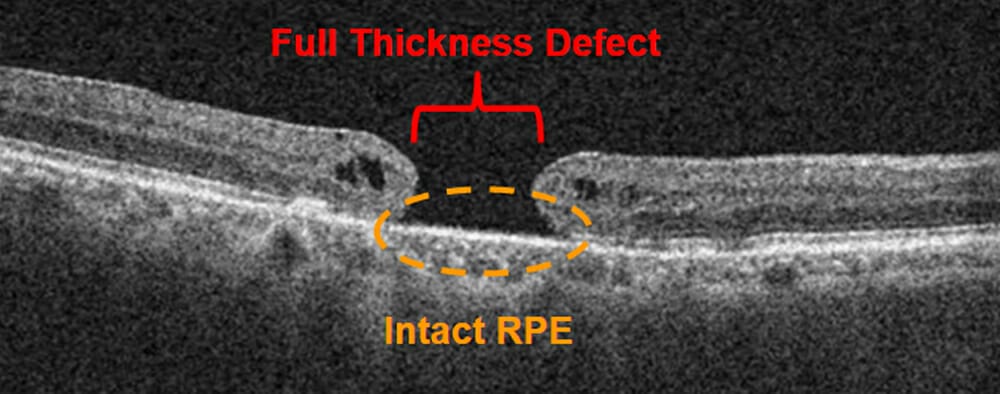 OCT and Me – A Beginner’s Guide - mivision