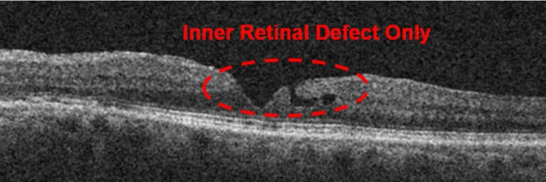 OCT and Me – A Beginner’s Guide - mivision