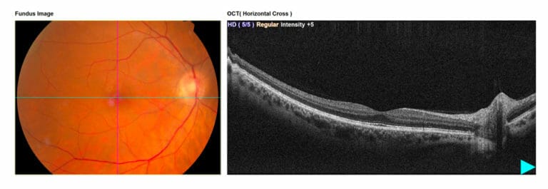 OCT and Me – A Beginner’s Guide - mivision