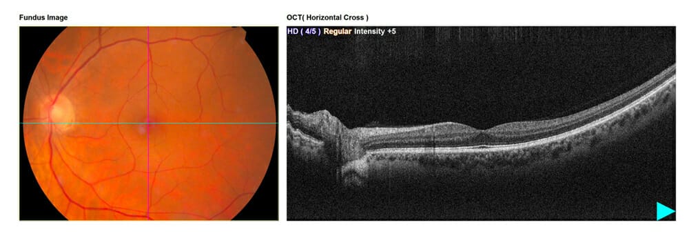 OCT and Me – A Beginner’s Guide - mivision