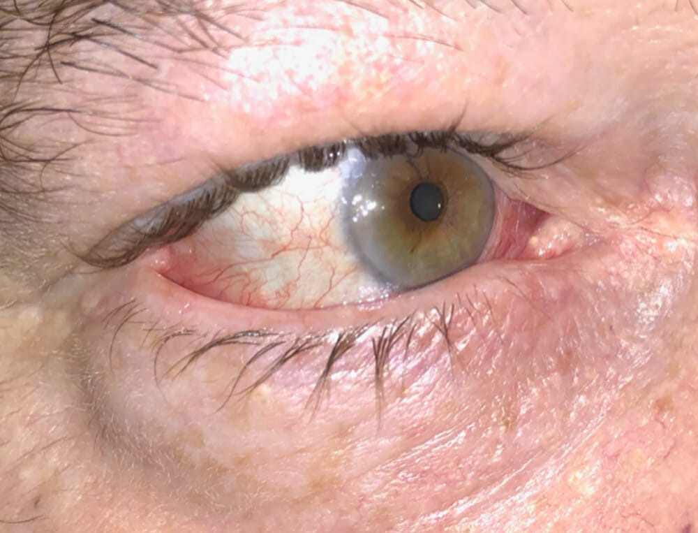 Ocular Surface Squamous Neoplasia - mivision