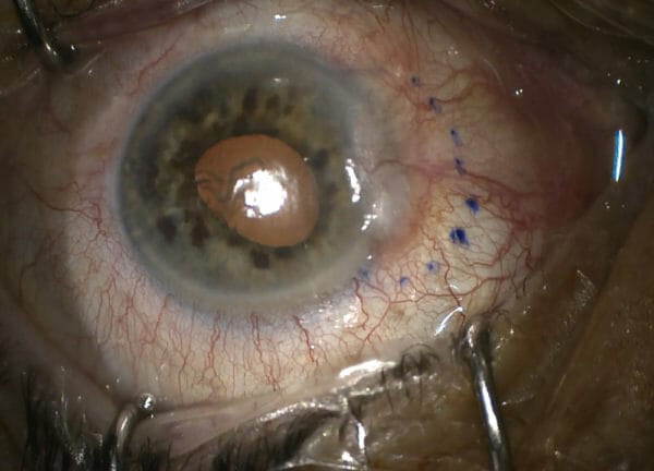 Ocular Surface Squamous Neoplasia - mivision