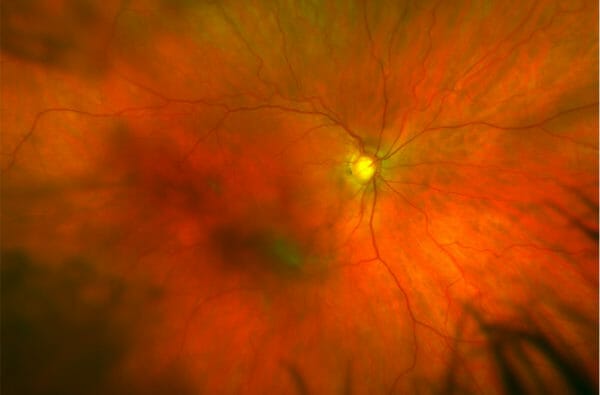 Degenerative Floaters: A Practical Review - mivision