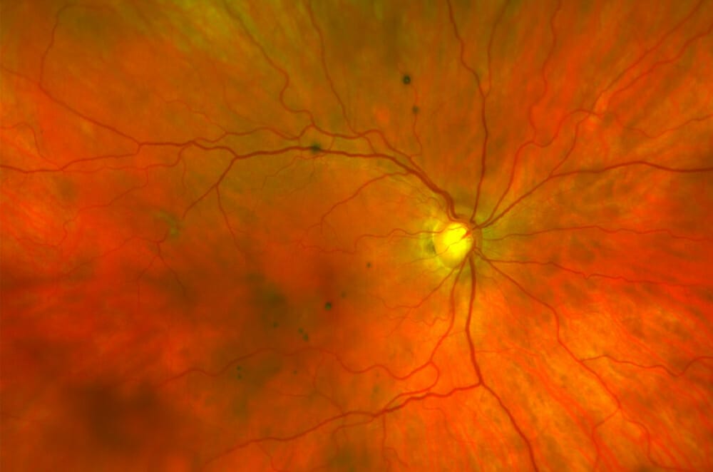 Degenerative Floaters: A Practical Review - mivision