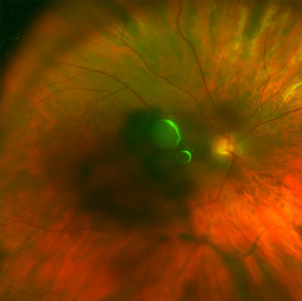 Degenerative Floaters: A Practical Review - mivision