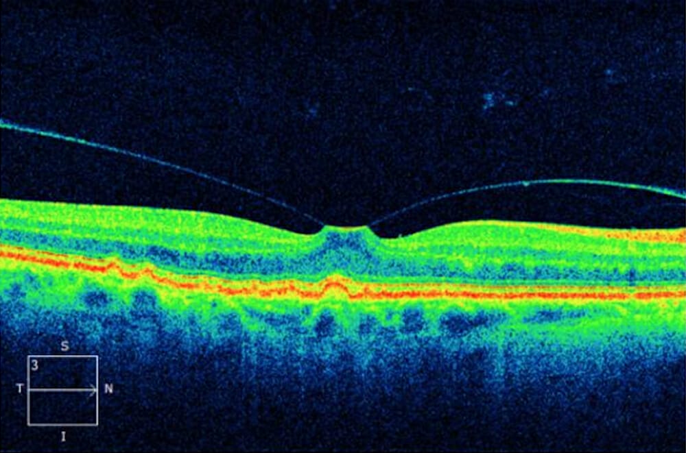 OCT and Me: A Beginner’s Guide - mivision