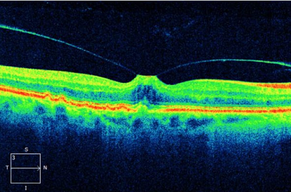 OCT and Me: A Beginner’s Guide - mivision