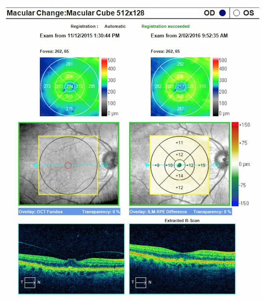 OCT and Me: A Beginner’s Guide - mivision