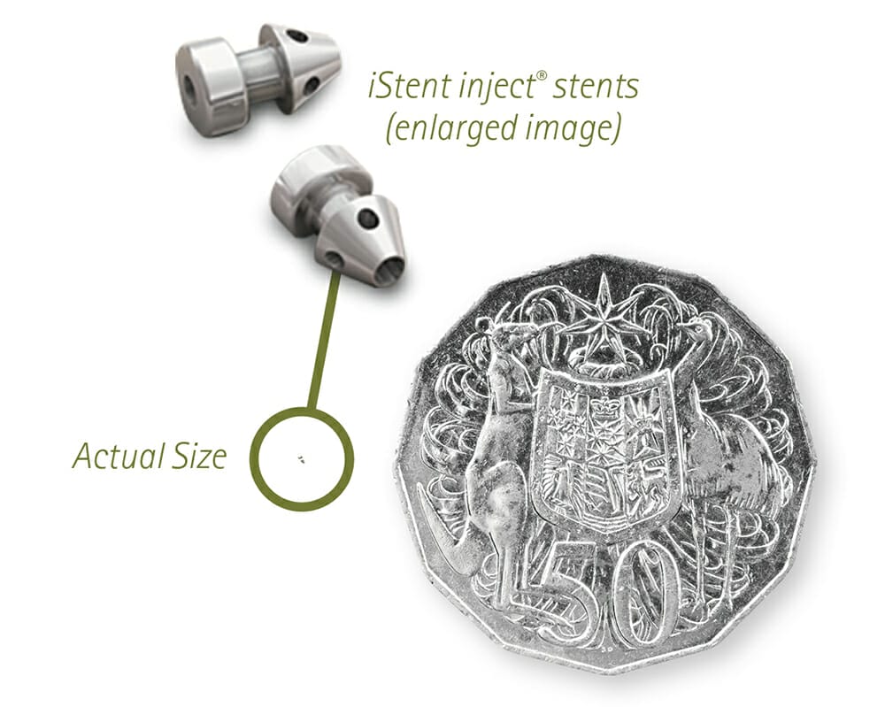 Cataract and Refractive Surgery: The Role of the iStent Inject - mivision
