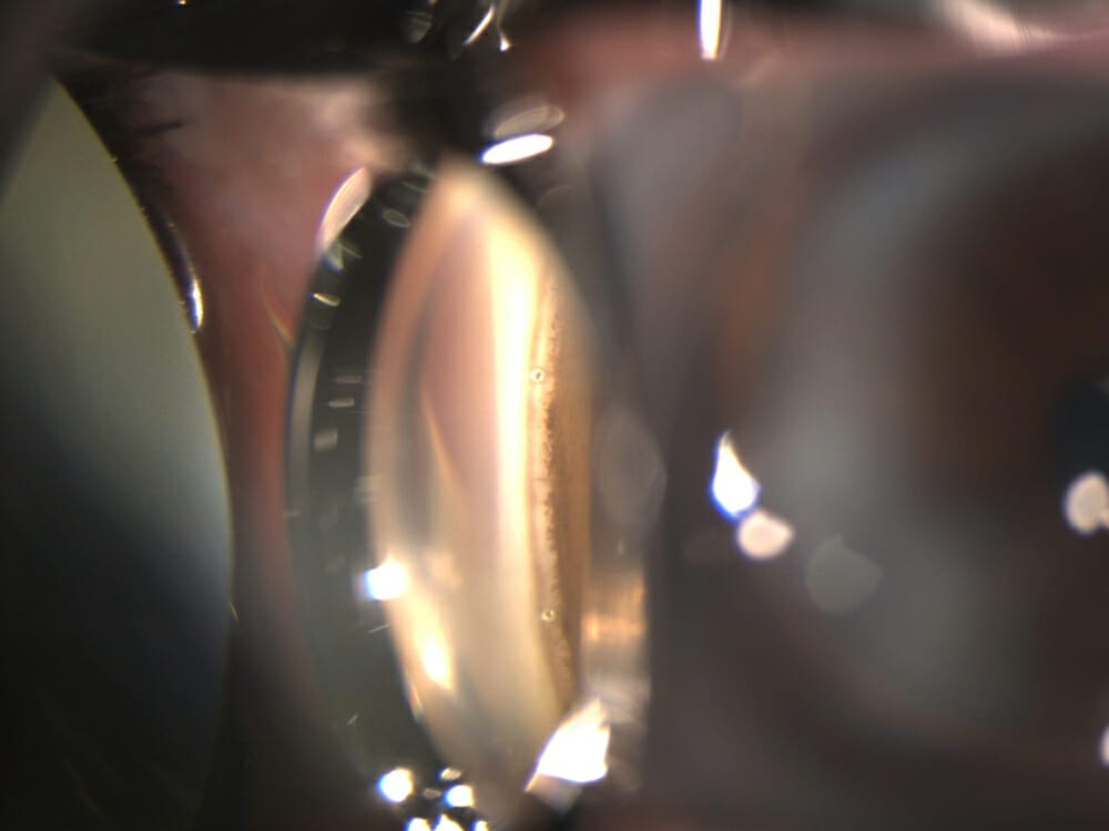 Cataract and Refractive Surgery: The Role of the iStent Inject - mivision