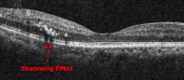 OCT and Me: A Beginner’s Guide - mivision