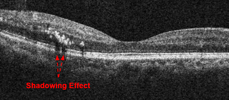 OCT and Me: A Beginner’s Guide - mivision
