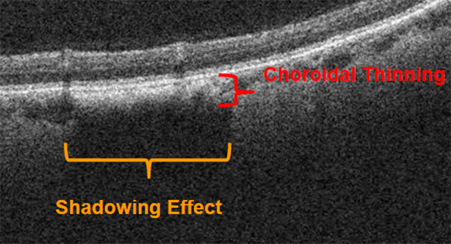 OCT and Me: A Beginner’s Guide - mivision