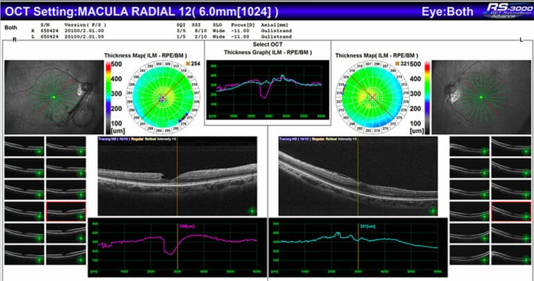 OCT and Me: A Beginner’s Guide - mivision
