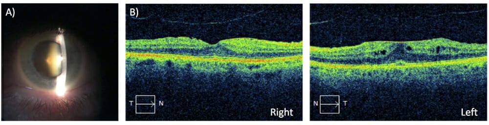 Cataract Surgery and Retinal Disease - mivision