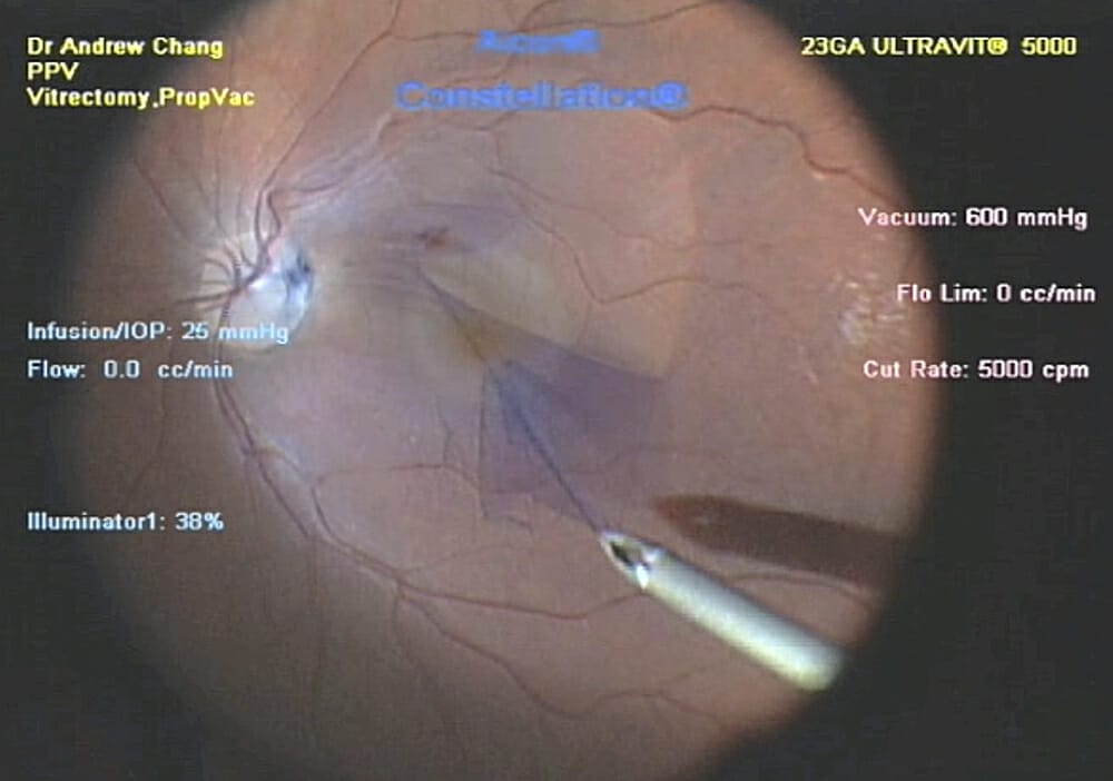 Surgical Retina – Evolution, Trends and Innovations - mivision