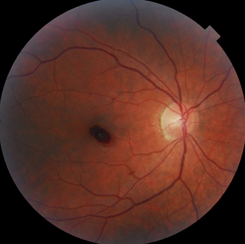 The Low Down on High Altitude Retinopathy - mivision