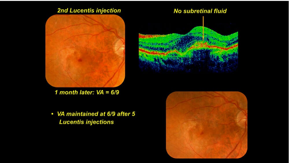 Optometry and Anti-VEGF Co-management - mivision