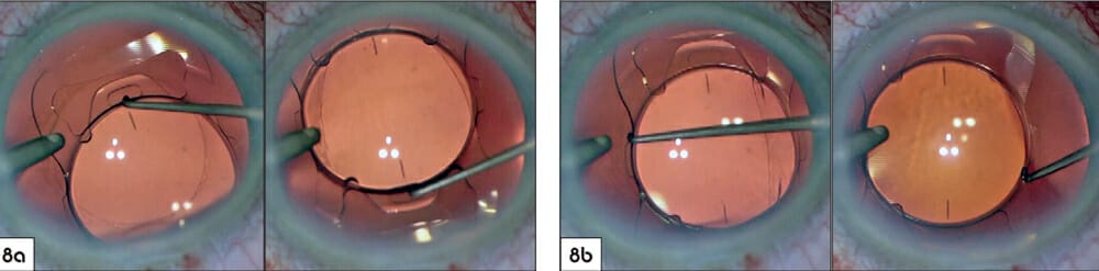 Femtis EDOF: Predictable Positioning, Clear Vision - mivision