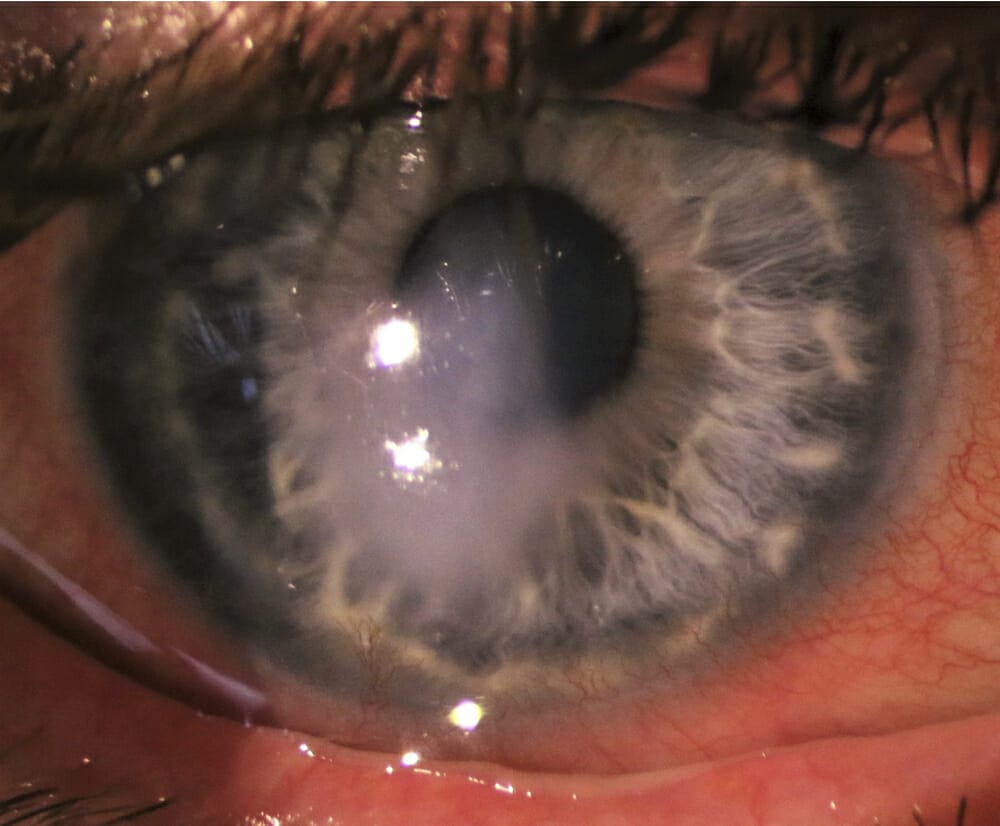 Patient Management from Keratoconus to Corneal Hydrops - mivision