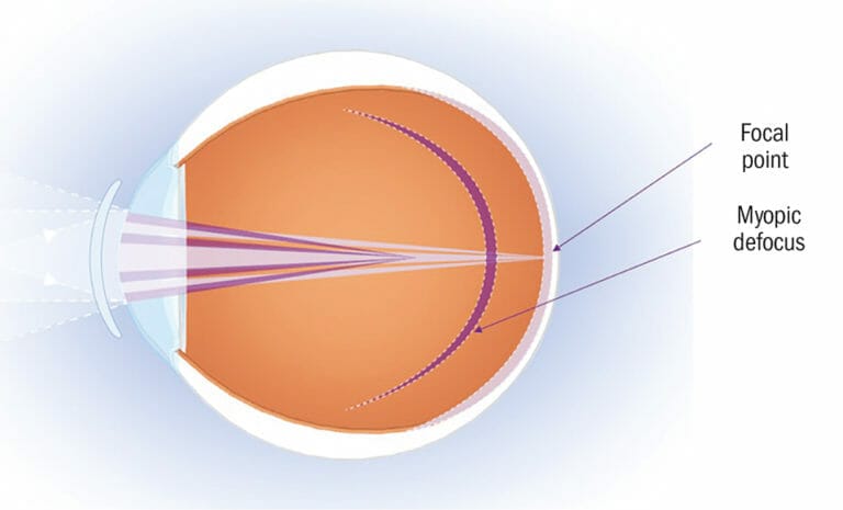 MiSight 1 day CLs for Myopia Control: Three-Year Milestone Results ...