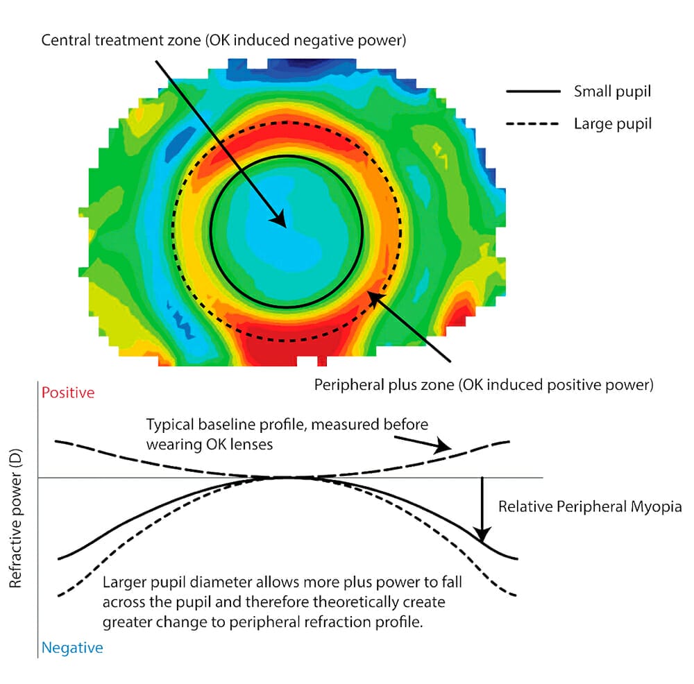 Orthokeratology: The Evidence is Here - mivision