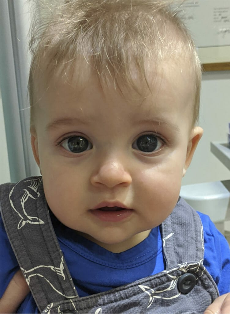 Childhood Glaucoma: Detection, Management & Impact - mivision