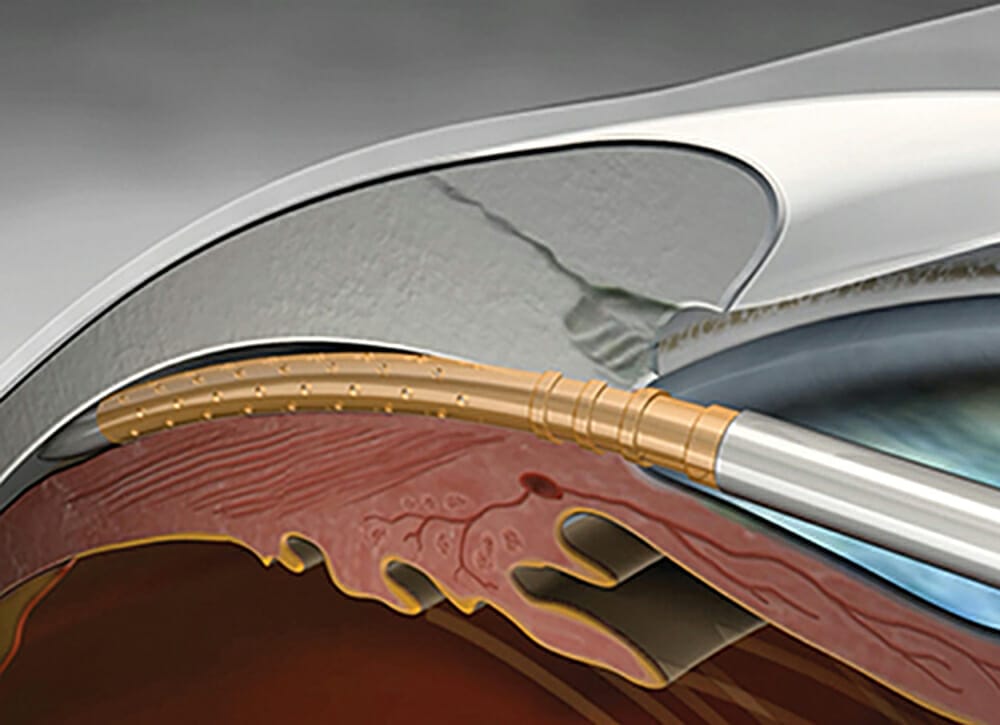Updates in Glaucoma Research - mivision