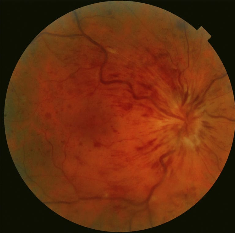 CRVO: Managing the Consequences - mivision