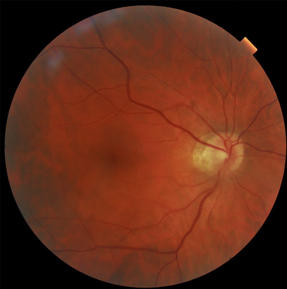 CRVO: Managing the Consequences - mivision