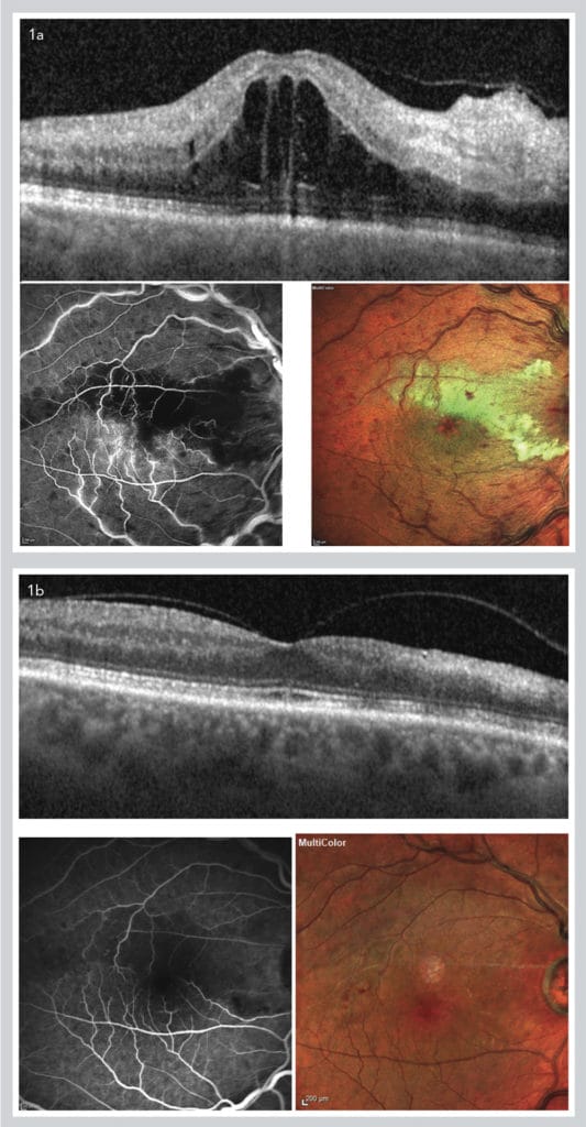 Intravitreal Injections & the Burden of Treatment for Macular Oedema ...
