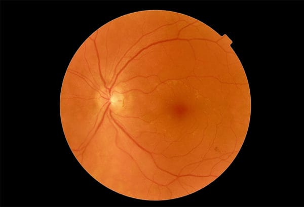 Epiretinal Membrane – A Practical Review - mivision